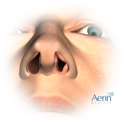 RhinAer and VivAer - Huntington ENT